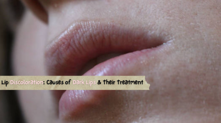 Understanding the Causes of Dark Lips and Effective Treatments – Typsy ...
